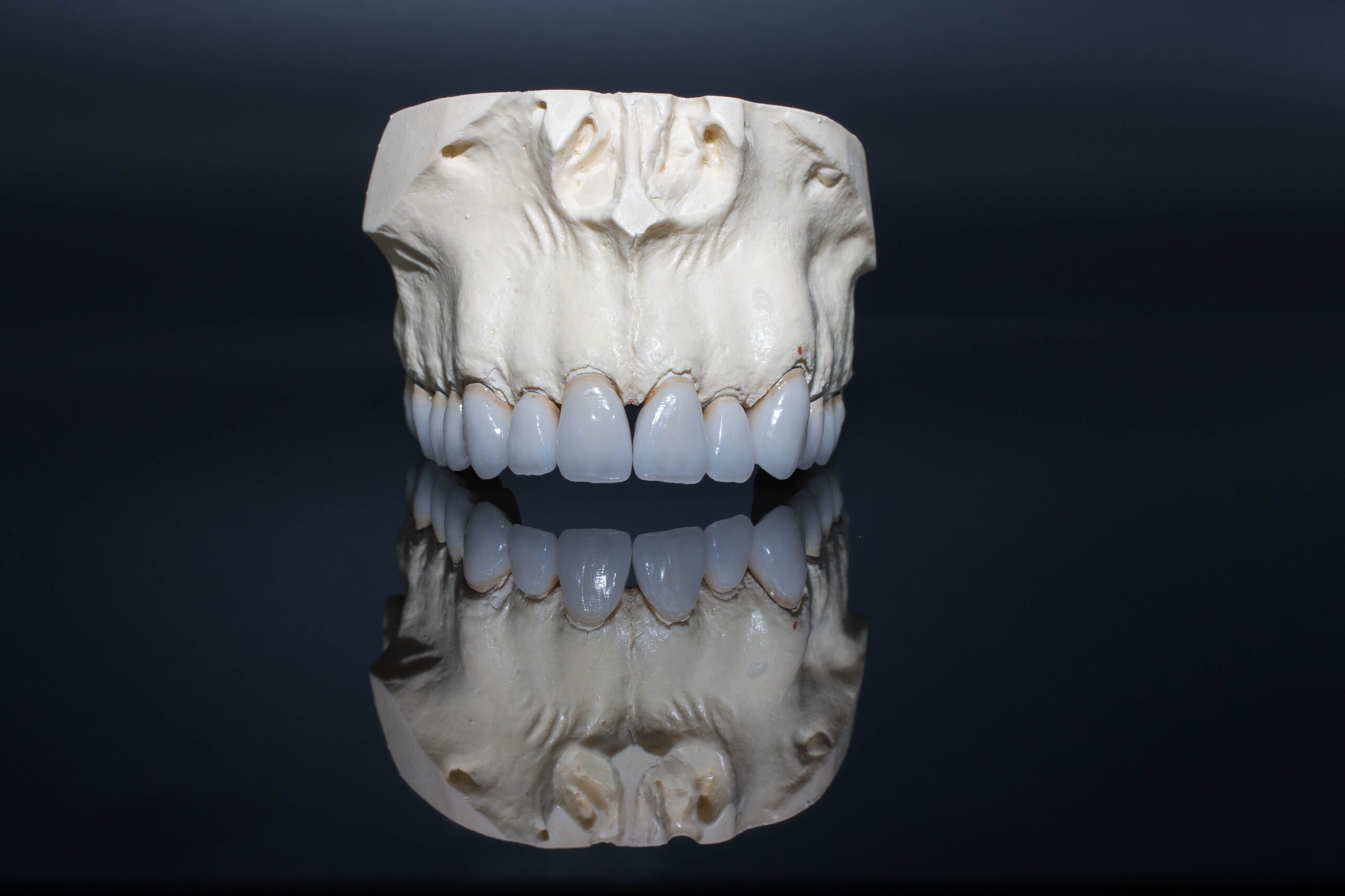 E-Max - Pros Dental Lab