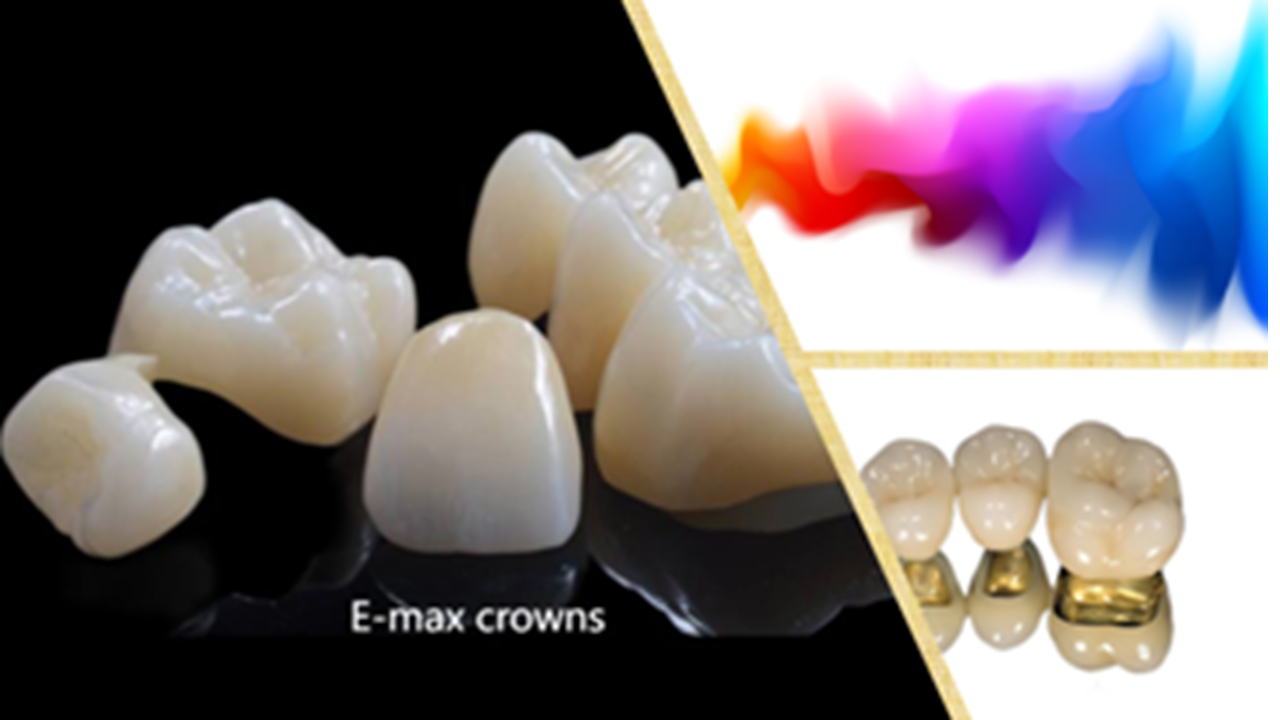 E-Max 1 - Pros Dental Lab